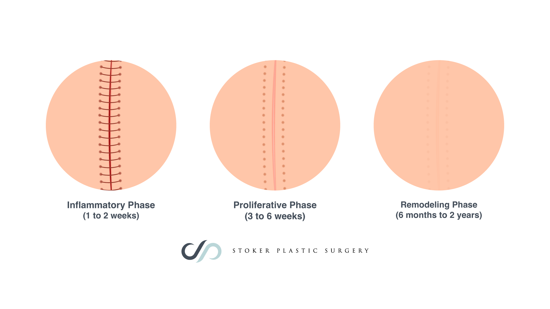 Nearly Invisible Facelift Scars? It’s True – Dr. David Stoker