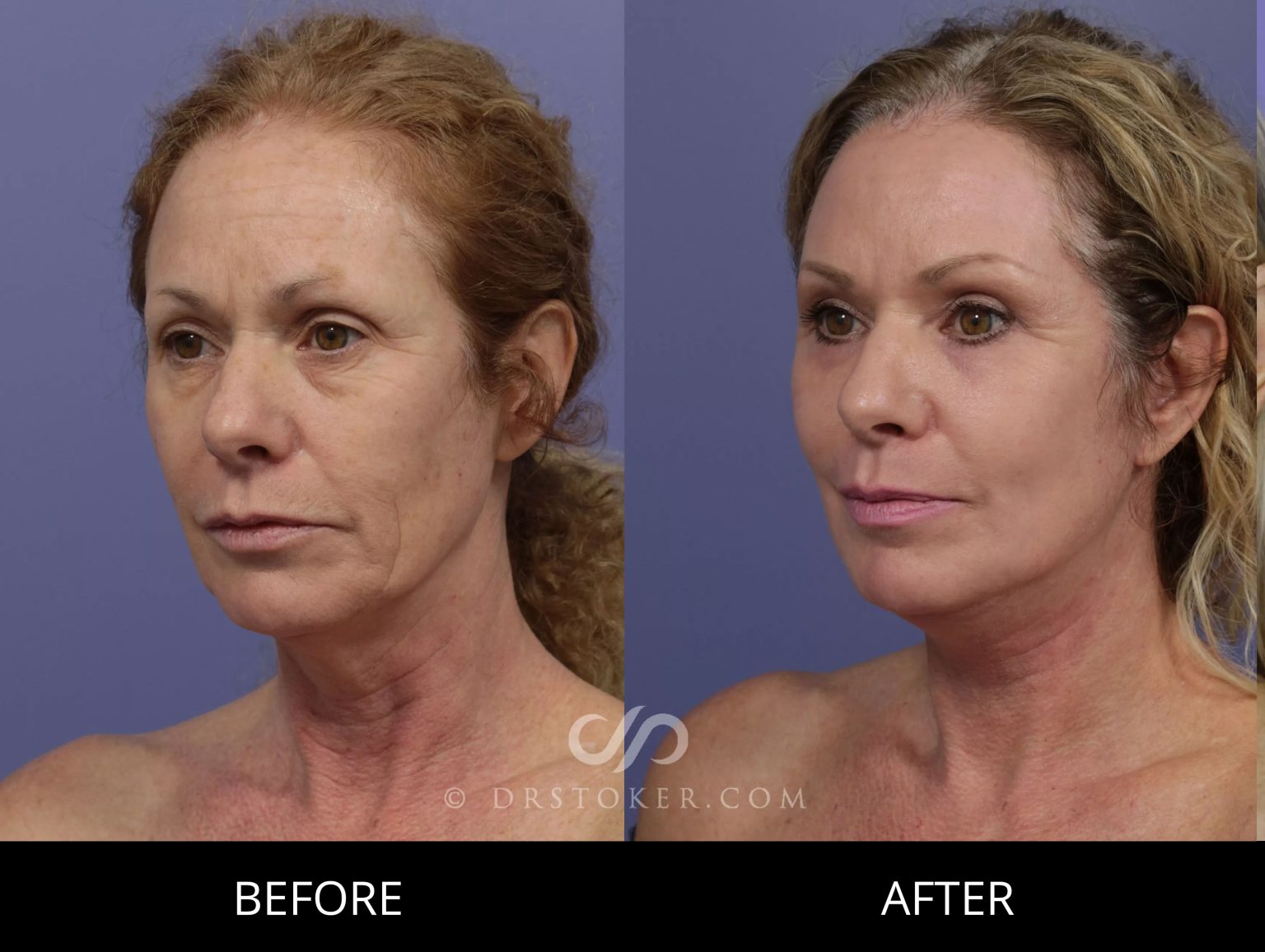 From Sagging to Sculpted: 5 Jaw-Dropping Jowl Cases – Dr. David Stoker