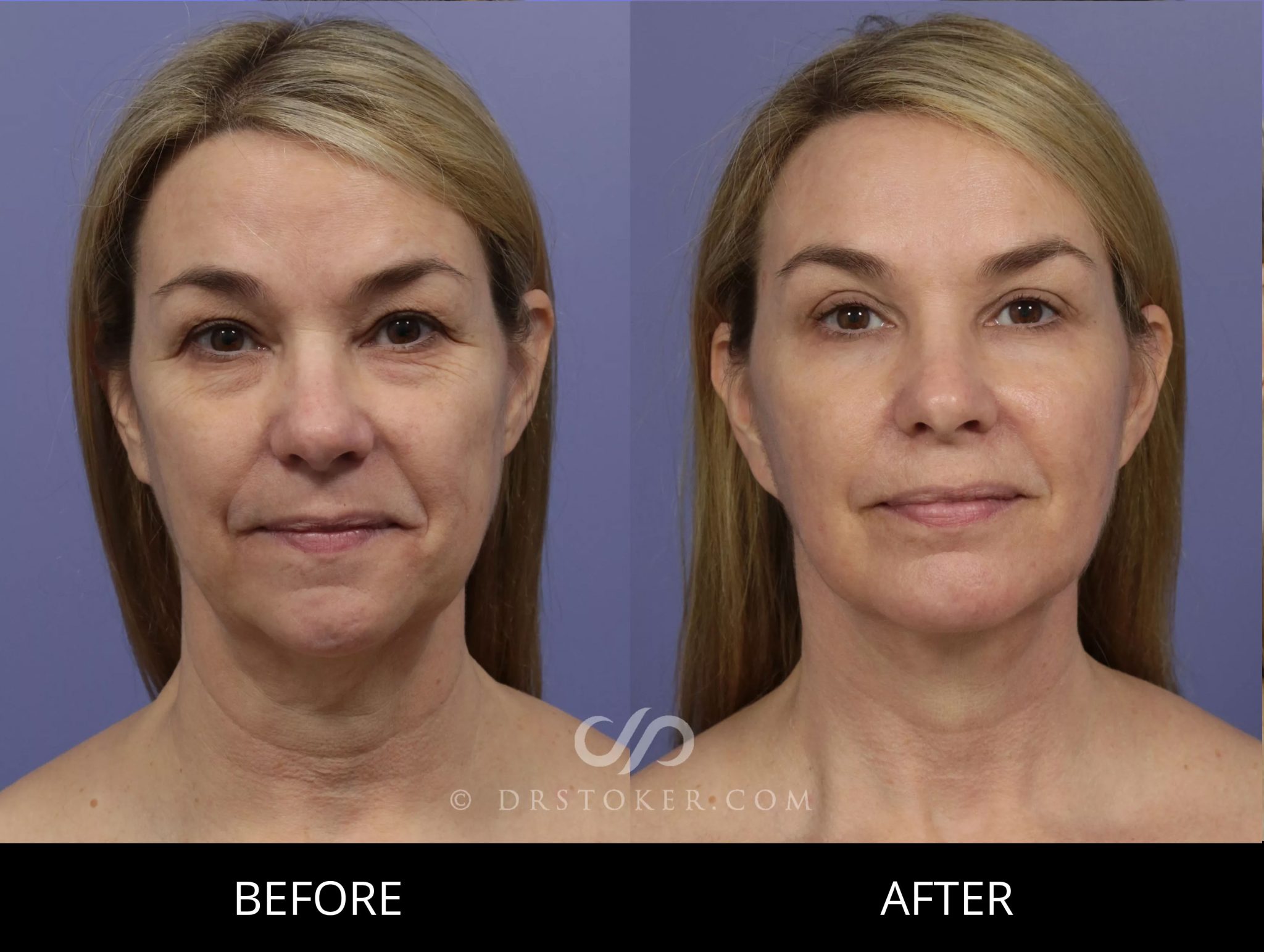 From Sagging to Sculpted: 5 Jaw-Dropping Jowl Cases – Dr. David Stoker