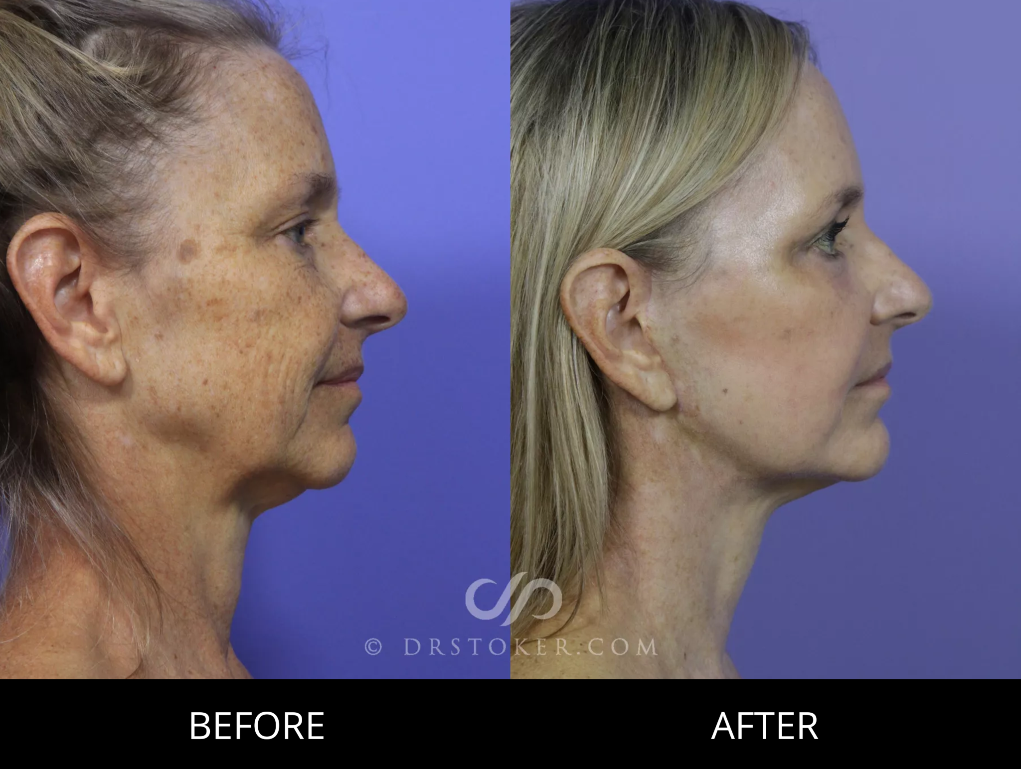From Sagging to Sculpted: 5 Jaw-Dropping Jowl Cases – Dr. David Stoker